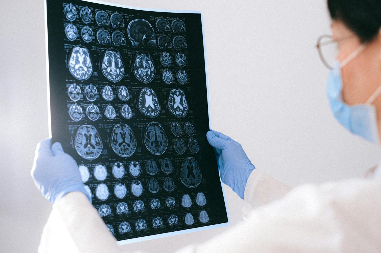 Amyloid-related imaging abnormalities (ARIA) – Code Team Pearls